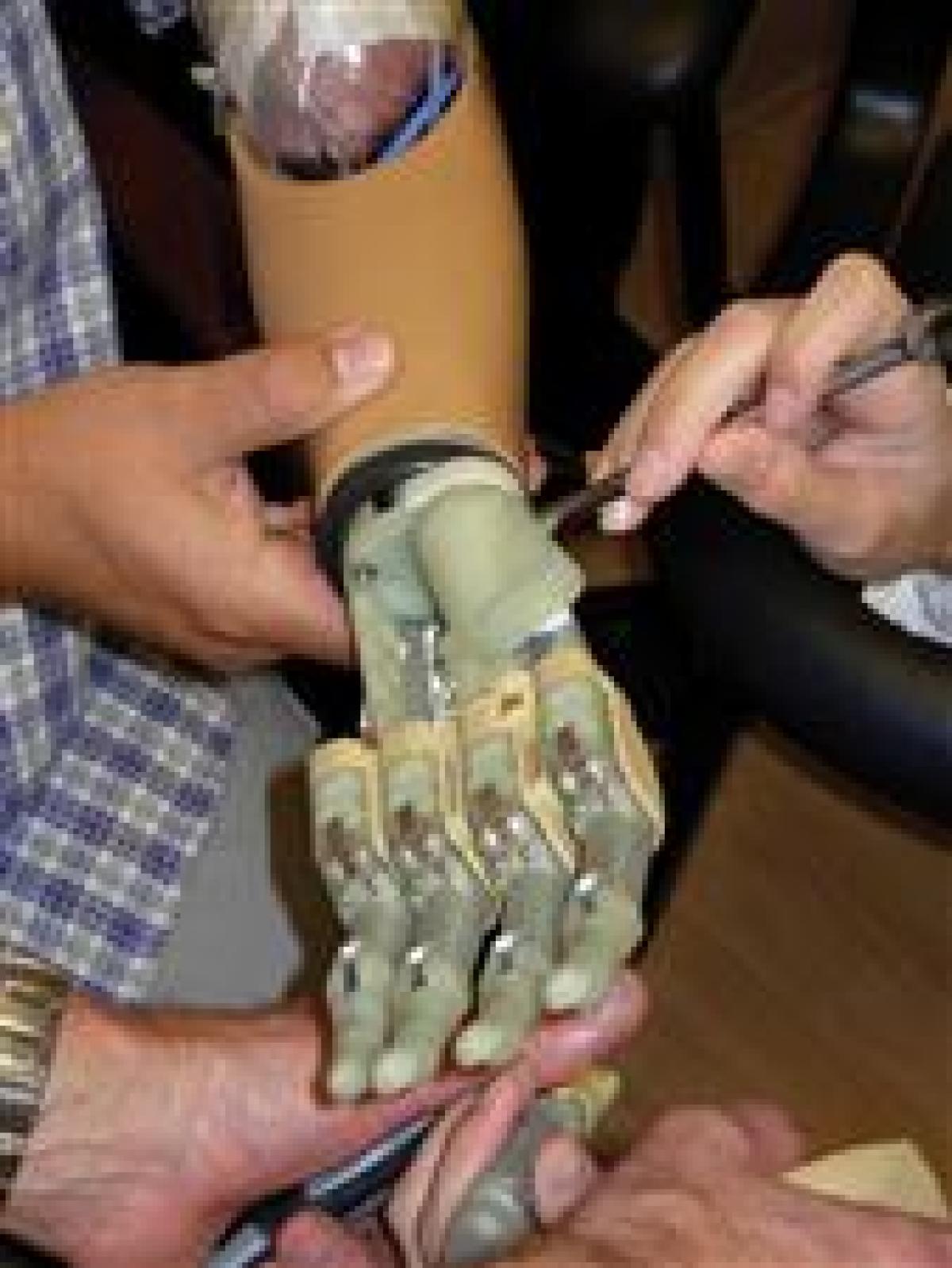 Prosthetics in the VA: Past, Present, and Future | Proceedings ...